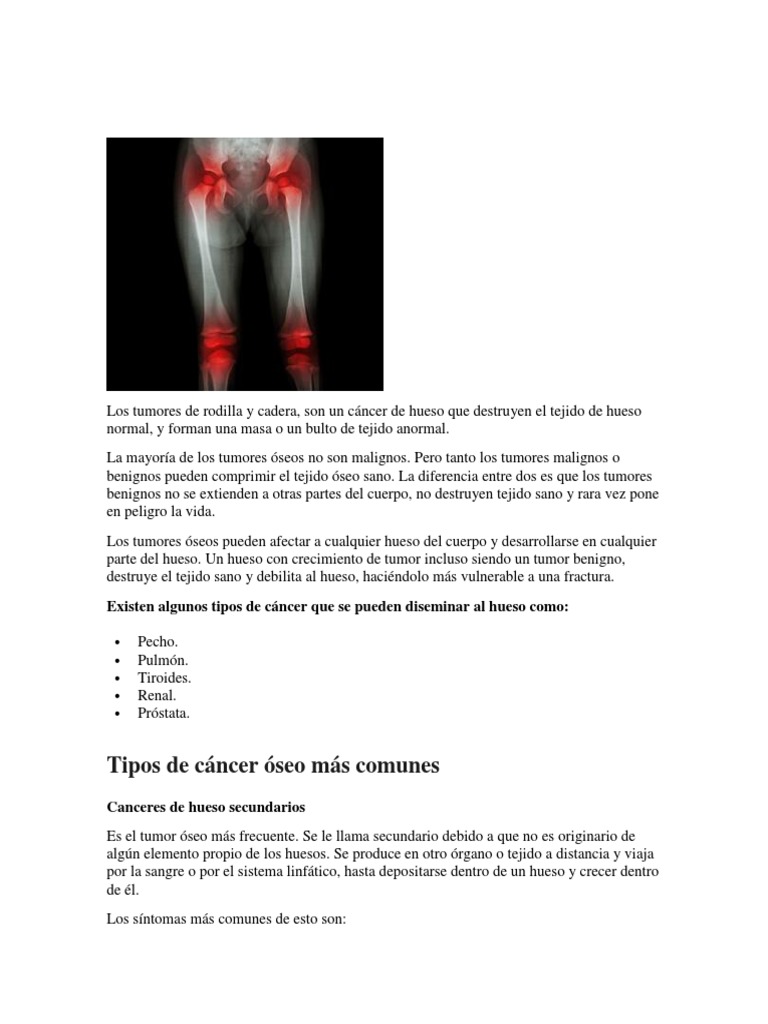 Tumores de Rodilla y Cadera | PDF | Cáncer | Hueso