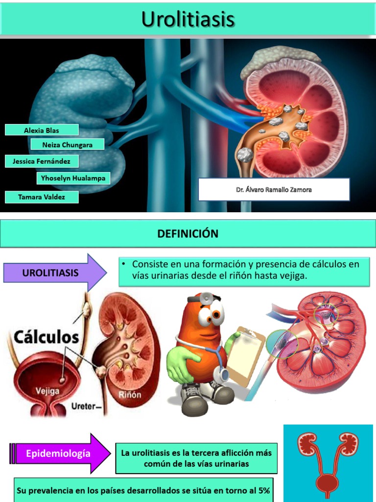 UROLITIASIS | Sistema urinario | Urología