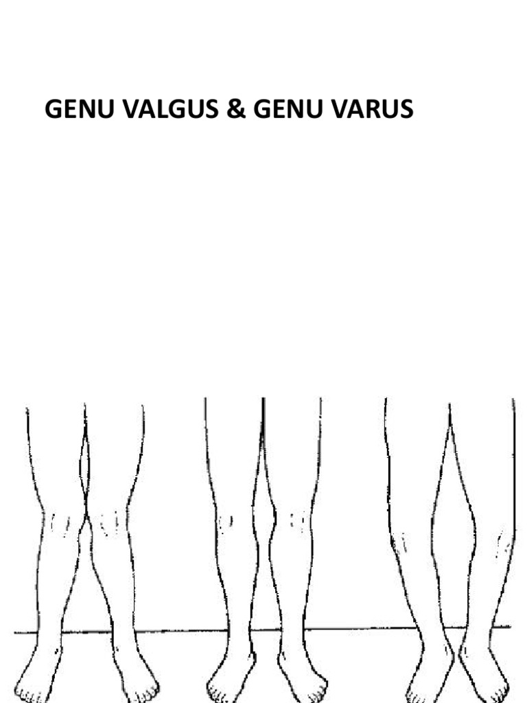Genu Valgus and Varus Overview | PDF | Knee | Epidemiology