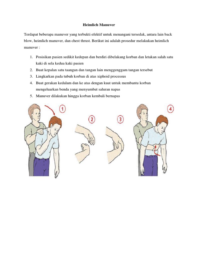 Heimlich Manuver | PDF