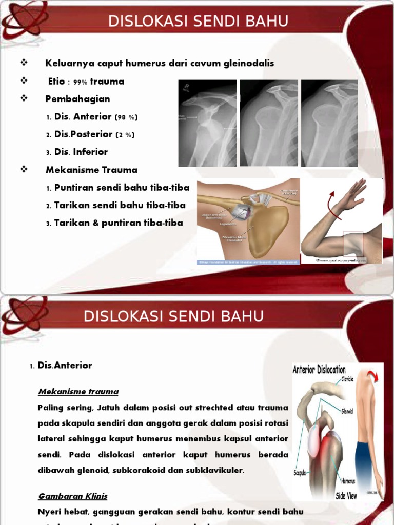 Dislokasi Sendi Bahu | PDF | Sains & Matematika