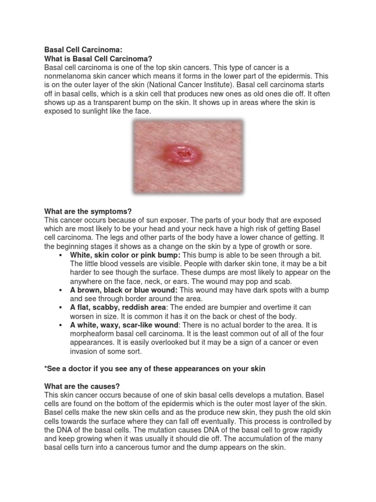 Skin Cancer Project | PDF | Sunscreen | Melanoma