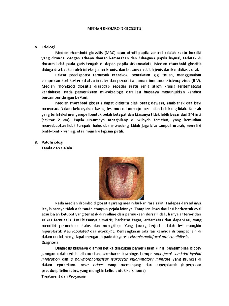 Median Rhomboid Glossitis | PDF