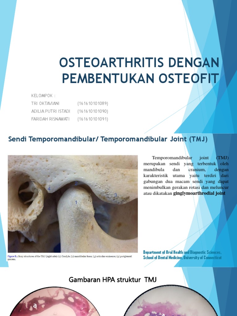 Fix Banget Osteoarthritis Dengan Pembentukan Osteofit (Autosaved) | PDF