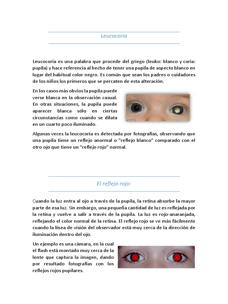 Leucocoria 1 | PDF | Ojo humano | Catarata