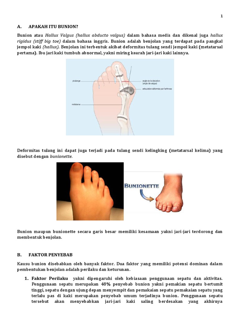 Hallux Valgus | PDF