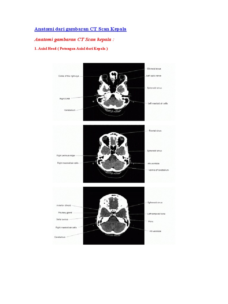 Dokumen - Tips - Anatomi Dari Gambaran CT Scan Kepala | PDF
