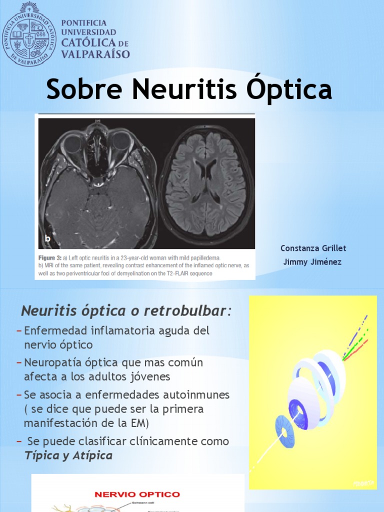 Neuritis Óptica | PDF | Óptica | Percepción visual