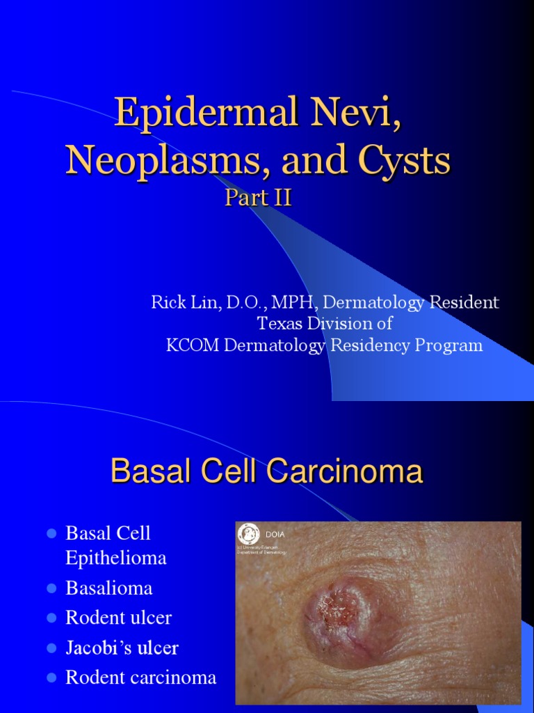 Epidermal Nevi, Neoplasms, and Cysts | PDF | Carcinoma | Skin Cancer
