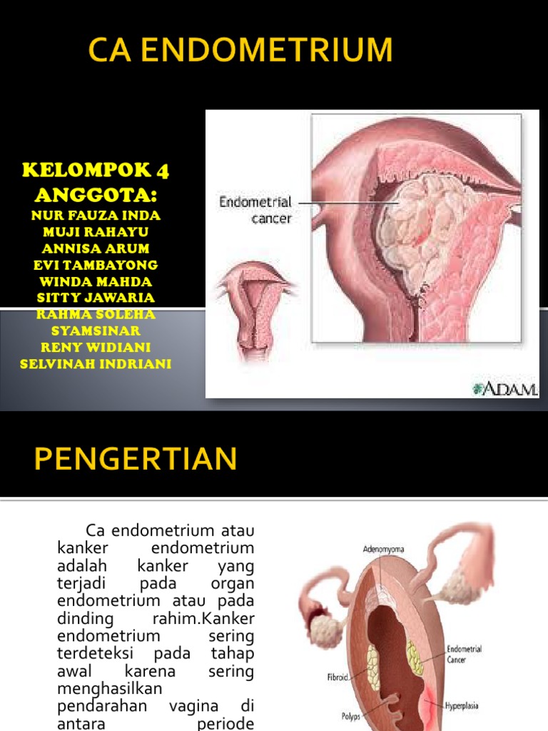 CA Endometrium | PDF