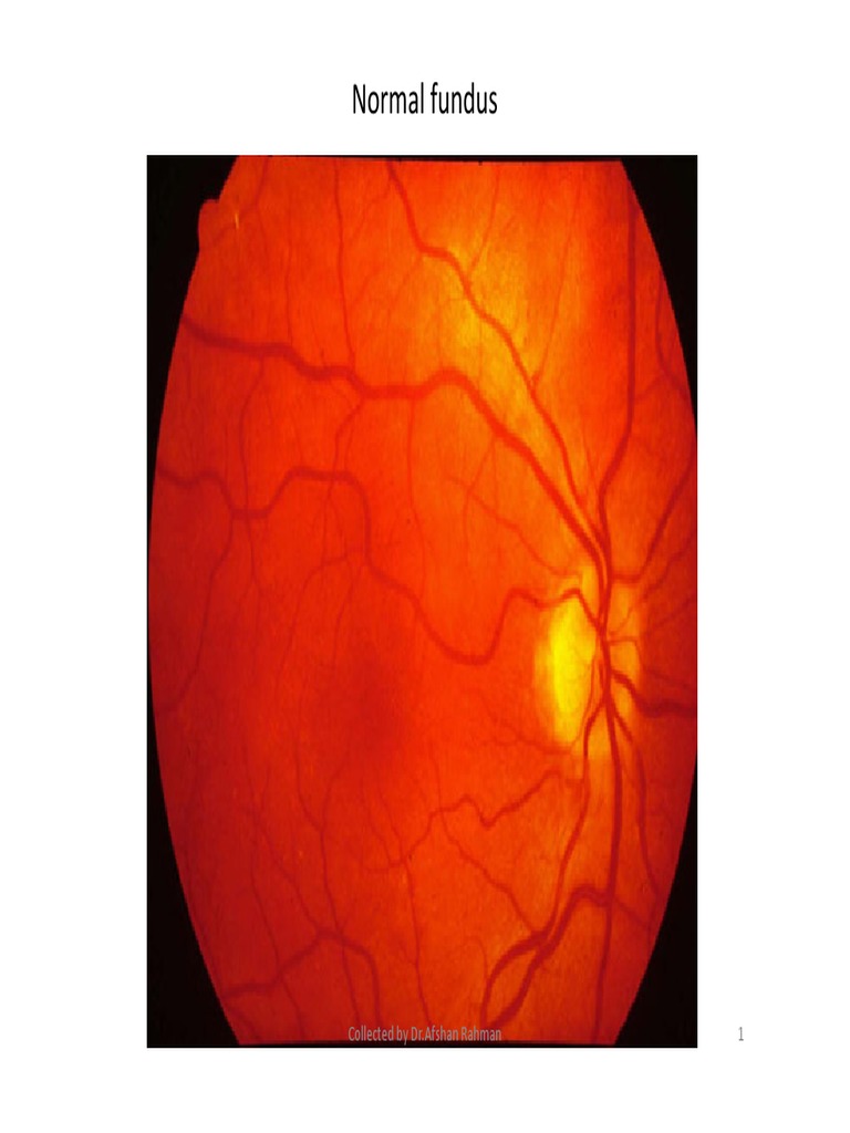 Normal Fundus: 1 Collected by DR - Afshan Rahman | PDF | Home & Garden ...