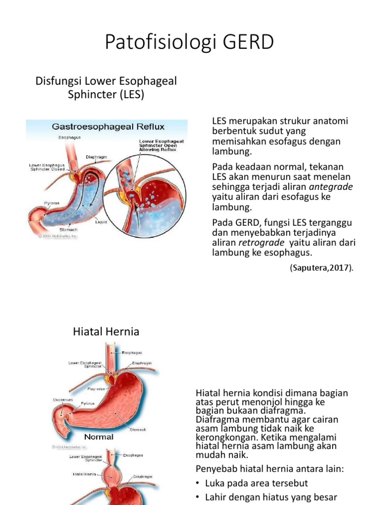 Patofisiologi GERD | PDF