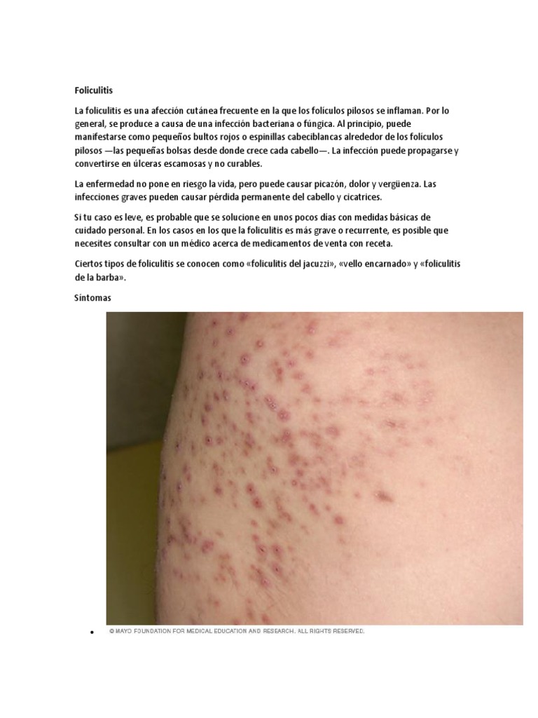 Síntomas y tipos de foliculitis | PDF | Barba | Piel