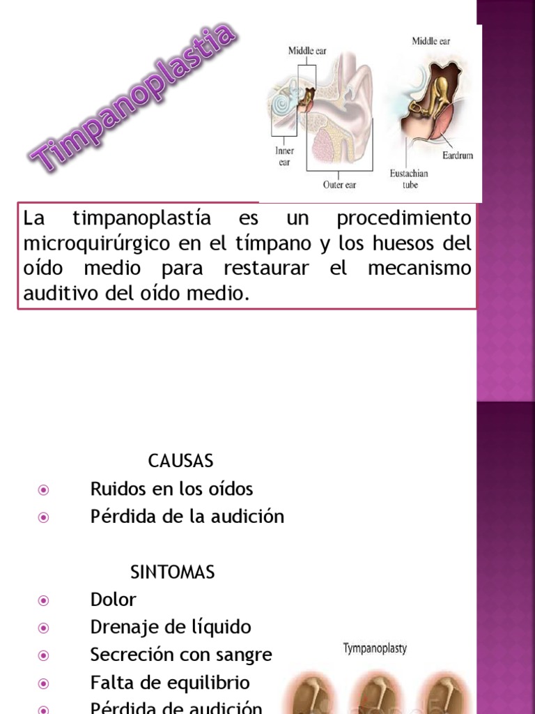 Timpanoplastia | PDF | Oído | Otología