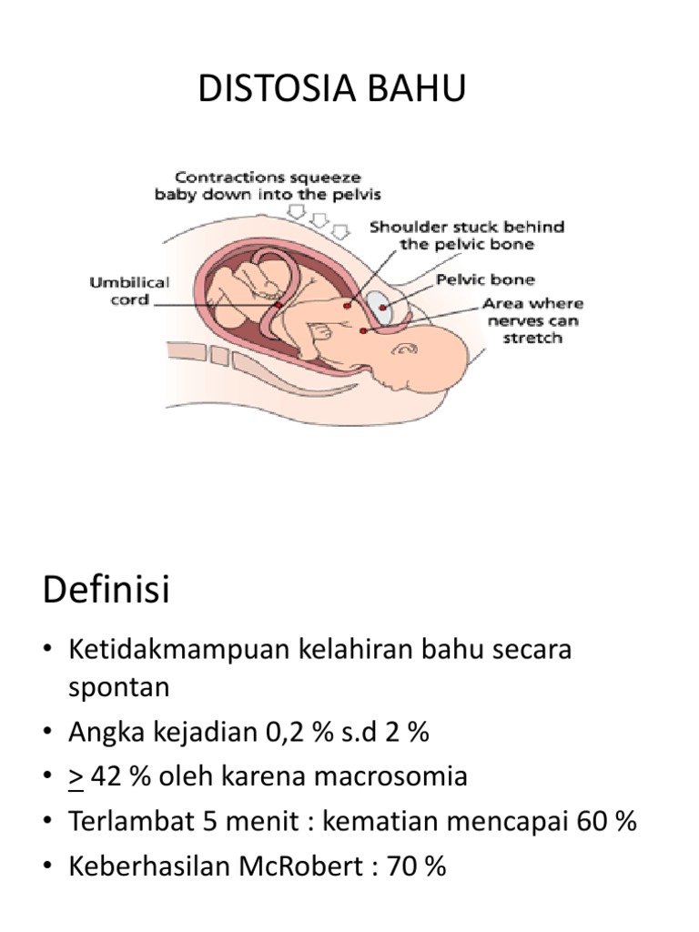 Penanganan Distosia Bahu dan Turtle Sign | PDF