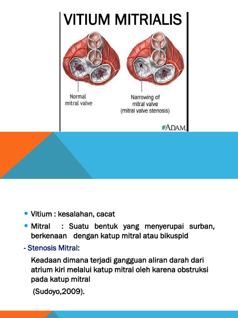 Vitium Mitralis | PDF