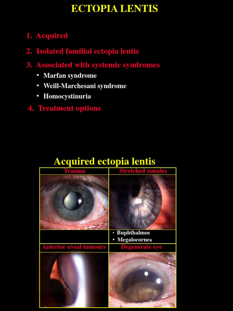 Ectopia Lentis: 1. Acquired 2. Isolated Familial Ectopia Lentis 3 ...