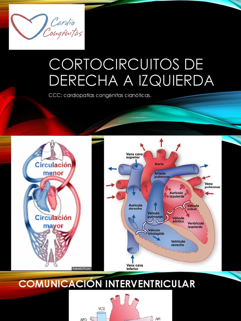 Shunts Derecha Izquierda | Defecto cardiaco congenito | Corazón