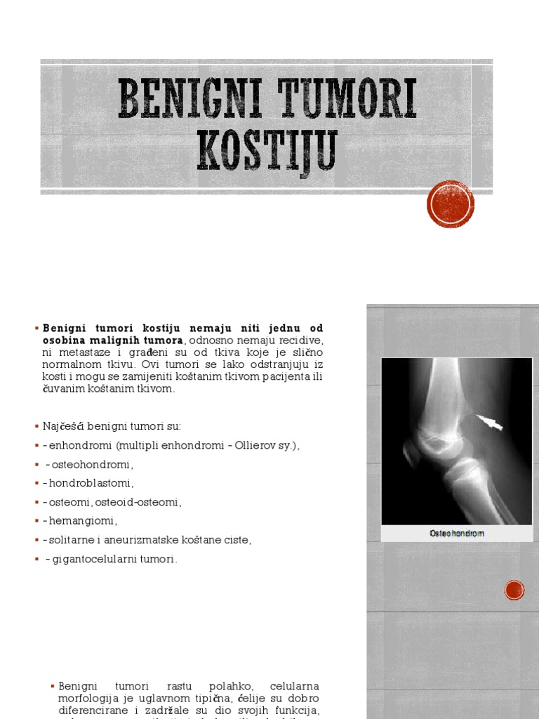 Benigni Tumoi Kosti | PDF