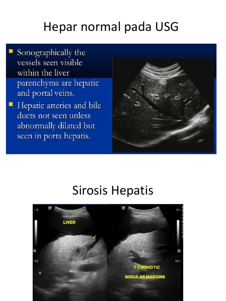 Sirosis Dan Urolitiasis Pada Usg | PDF