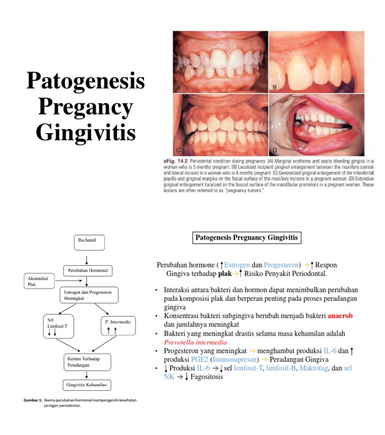 Patogenesis Pregancy Gingivitis | PDF