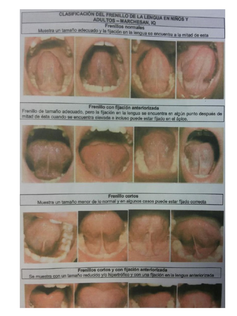 Clasificacion Del Frenillo Lingual en Niños | PDF