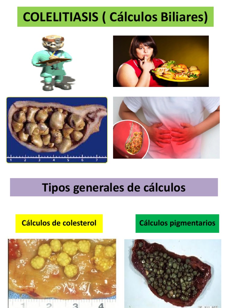COLELITIASIS | PDF