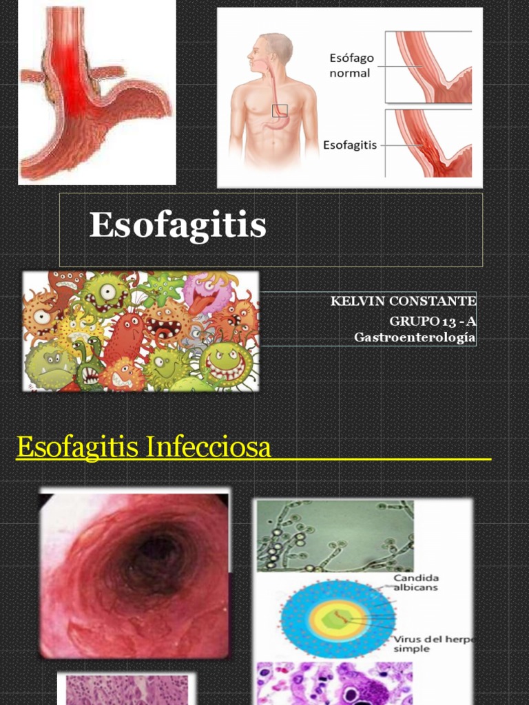 ESOFAGITIS | PDF | Gastroenterología | Epidemiología