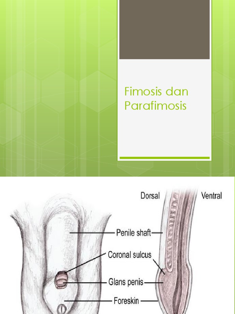 Phimosis Dan Paraphimosis | PDF