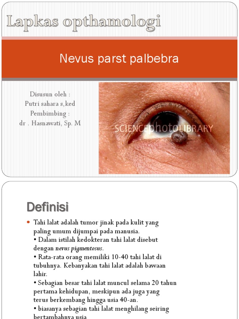 Nevus Lapkas | PDF