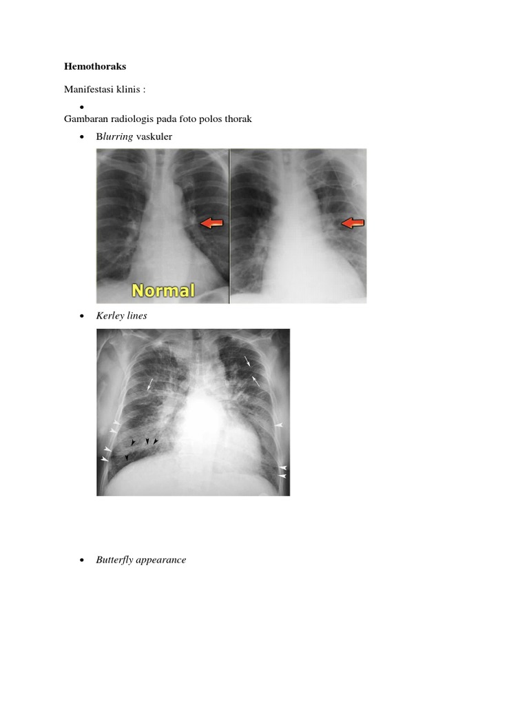 Edema Paru Dan Kontusio Paru | PDF