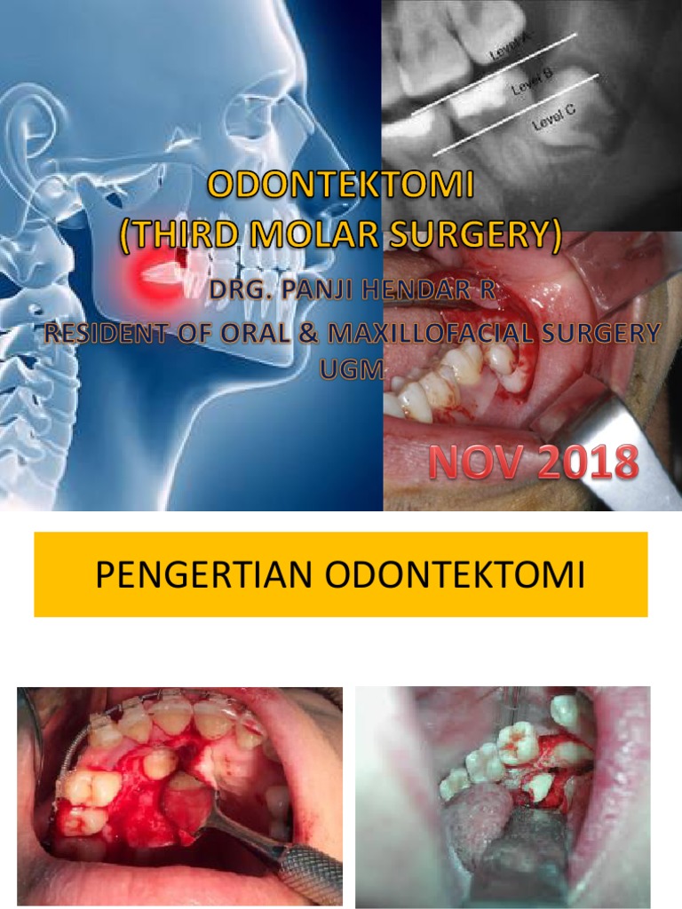 Odontektomi Procedure | PDF | Orthodontics | Dentures