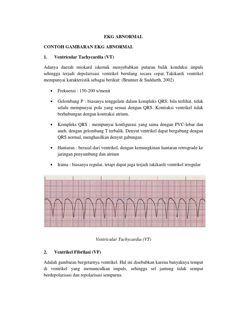 Ekg Abnormal | PDF
