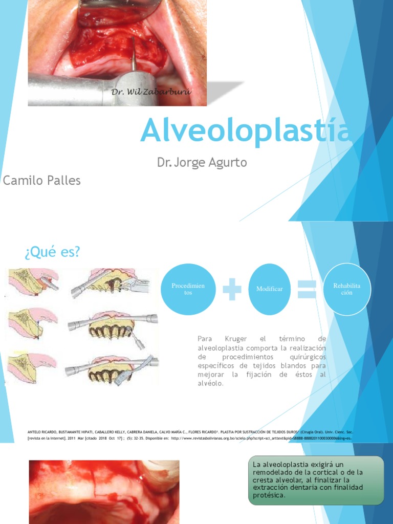 Alveoloplastía | Hueso | Cirugía Oral y Maxilofacial