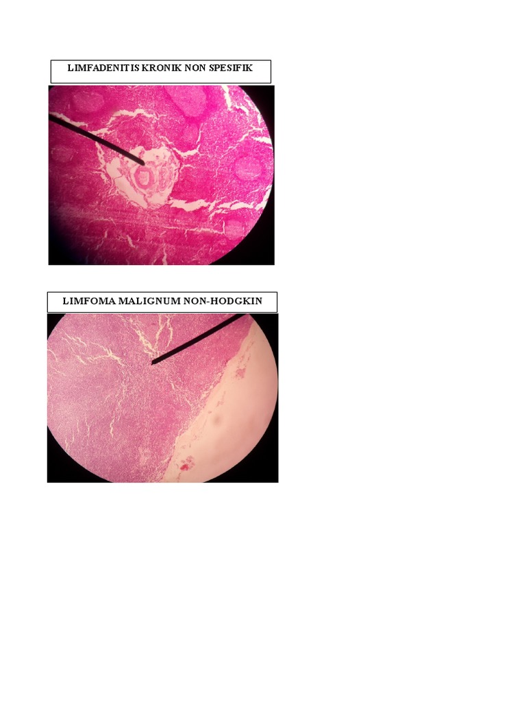 Limfadenitis Kronik Non Spesifik: Limfoma Malignum Non-Hodgkin | PDF