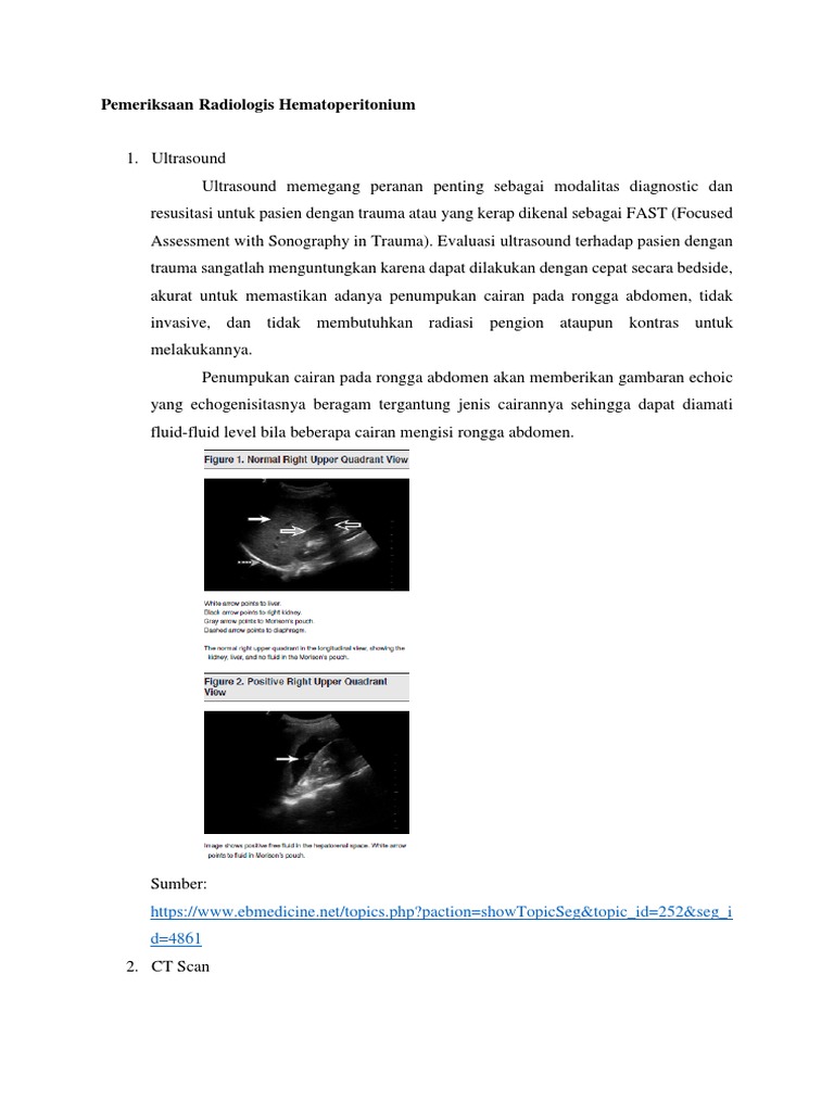 Hematoperitoneum | PDF