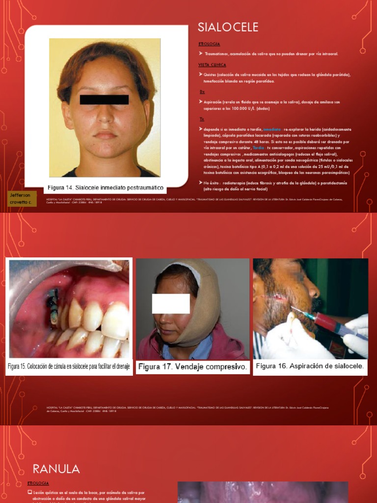 Tratamiento del Sialocele y Ranula | PDF | Saliva | Lesión