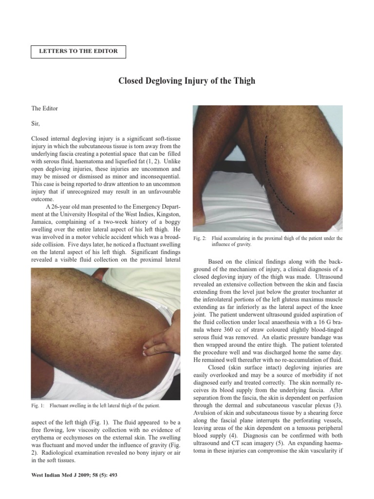 Article Closed Degloving | Download Free PDF | Health Sciences | Medicine