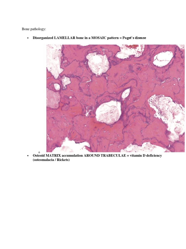 Disorganized LAMELLAR Bone in A MOSAIC Pattern Paget's Disease | PDF