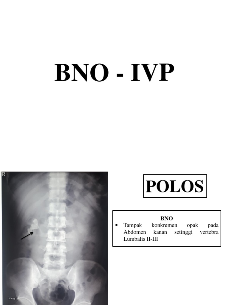 Bno - Ivp | PDF