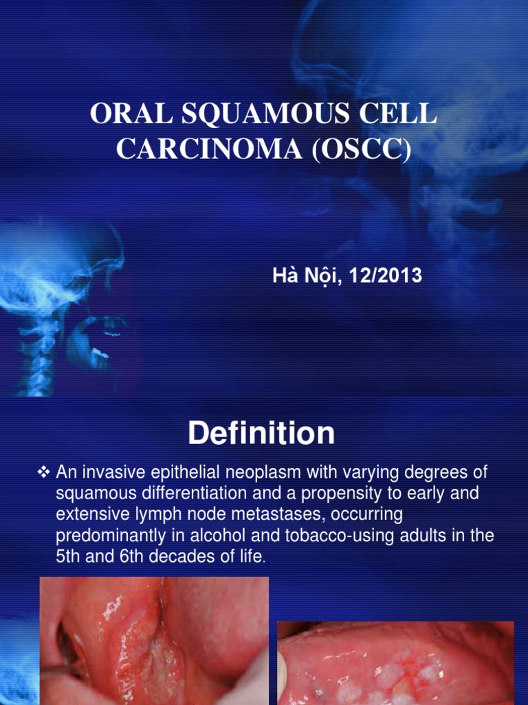 Oral Squamous Cell Carcinoma (Oscc) | PDF | Radiation Therapy | Therapy