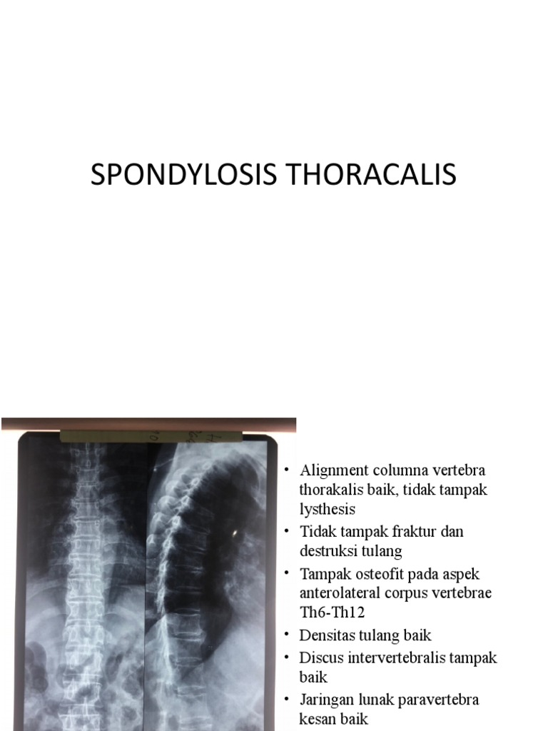 DEGENERASI DISKUS INTERVERTEBRALIS DAN PENGENALAN OSTEOFIT PADA ...