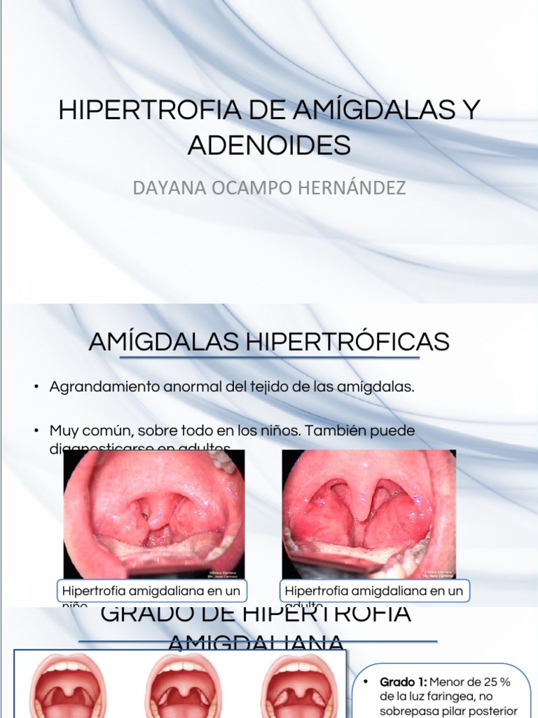 Hipertrofia de Amígdalas y Adenoides PDF | PDF | Enfermedades y ...