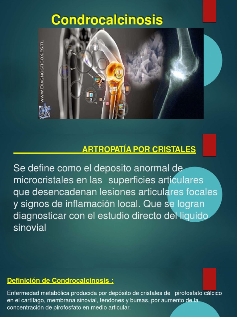 Condrocalcinosis 171121235936 | PDF | Glucocorticoides | Rodilla