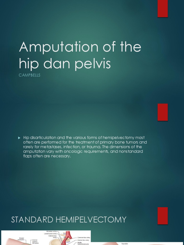 Amputation of The Hip Dan Pelvis | PDF