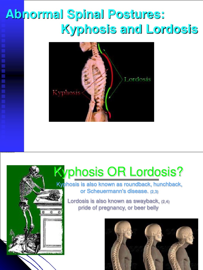 Abnormal Spinal Postures Kyphosis and Lordosis | PDF | Vertebral Column ...