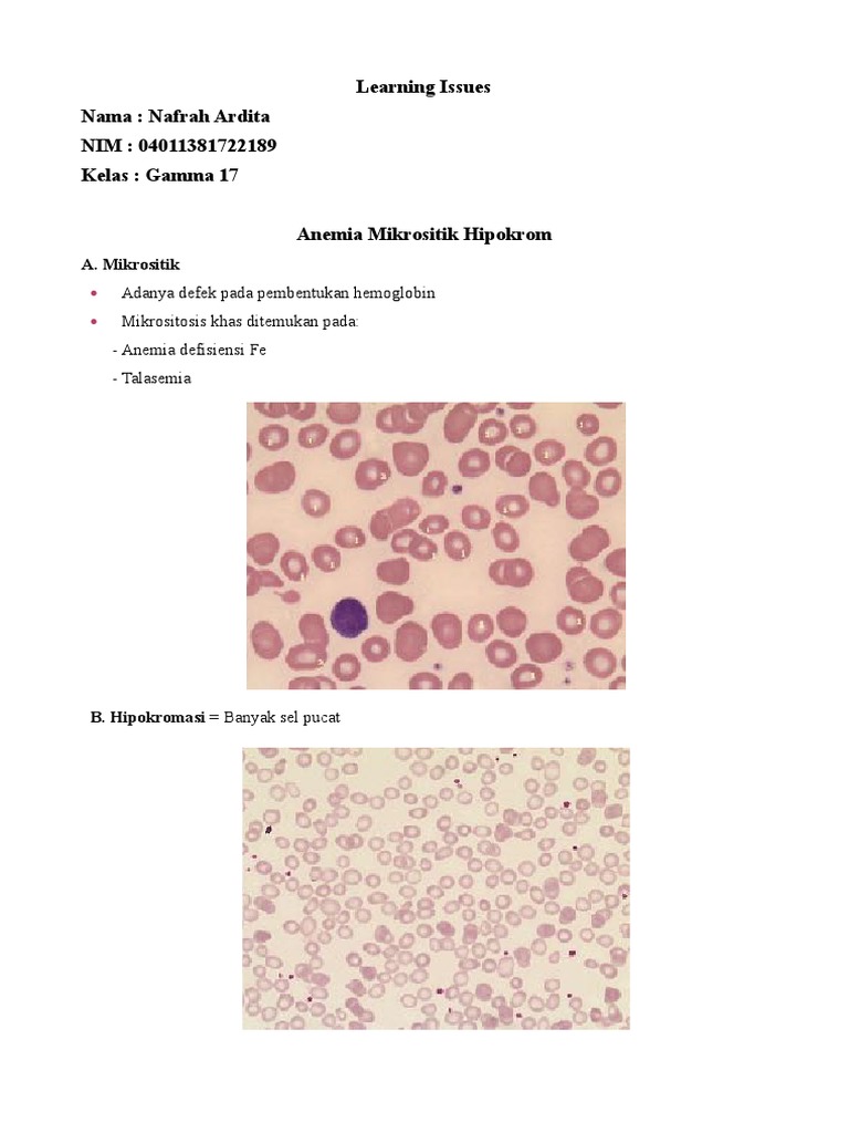 Anemia Mikrositik Hipokrom | PDF