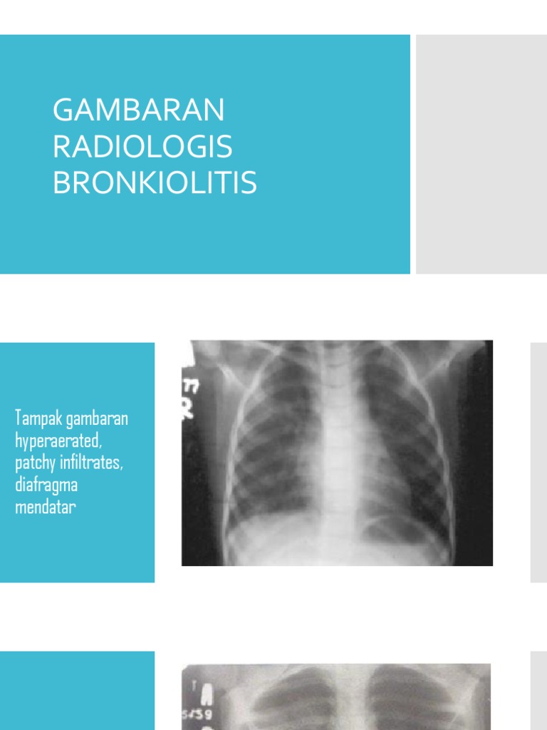 Gambaran Radiologis Bronkiolitis | PDF