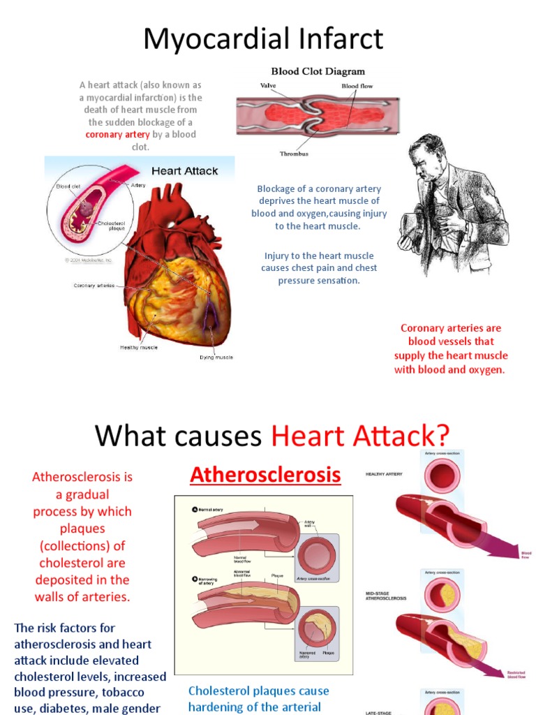 Coronary Artery Blockage Leads to Myocardial Infarction: Understanding ...