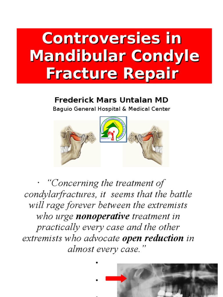 Controversies in Condylar Fracture Repair Untalan | PDF | Surgery | Dentistry
